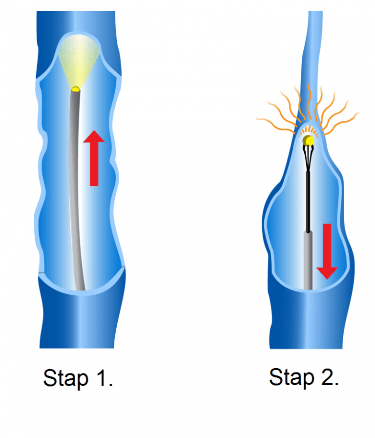 Spatader behandelingen - Spataderarts Den Haag